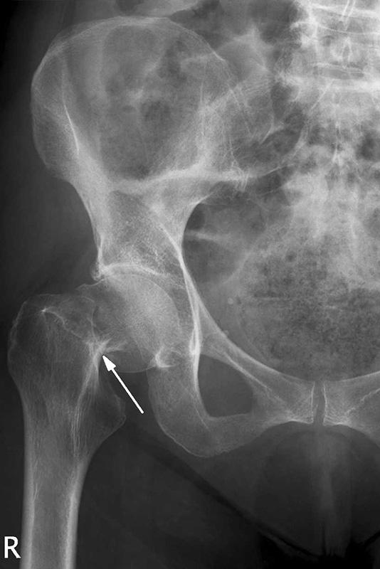 Prothèse de hanche pour fracture du col du fémur Marseille